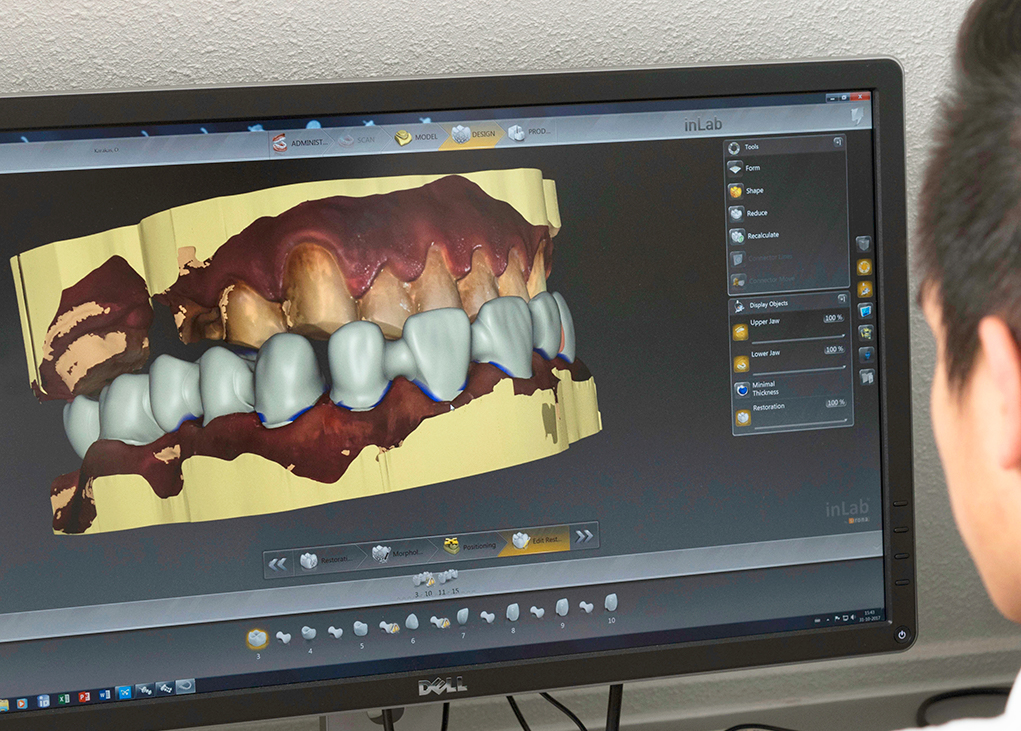 Guided implantologie - Prodens